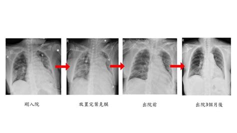 換腎女確診重症「雙肺一片白」 裝葉克膜35天成功搶命 祝你健康 三立新聞網 Healthsetncom