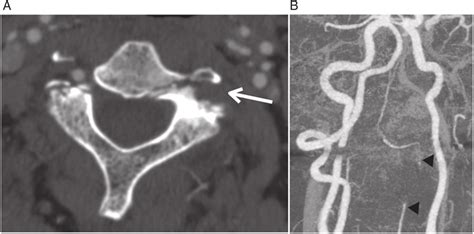 A Axial View Of Cta Showed A Filling Defect Consistent With Left Va