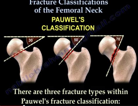 Femoral Neck Fracture Classification —