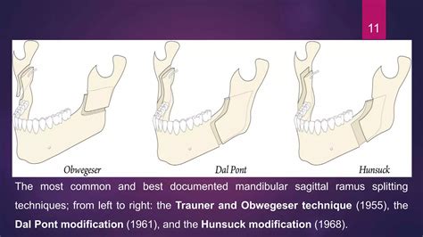 Journal Club Bad Splits In Bilateral Sagittal Split Osteotomy