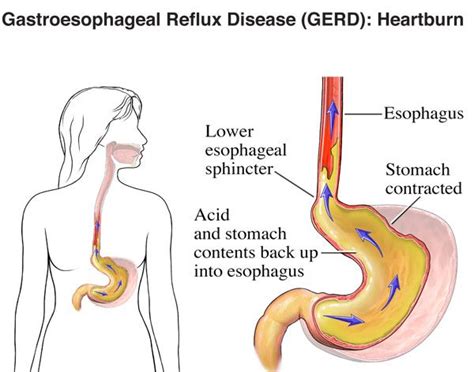 Gastric Reflux Heartburn Healthdirect
