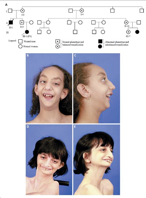 Monosomy Disorders 2