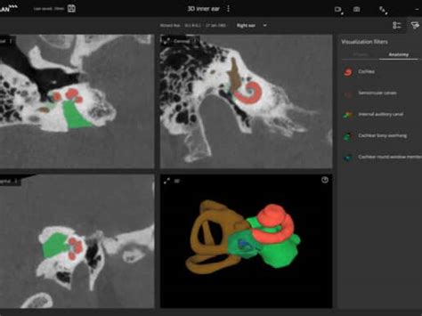 New Features In Otoplan Enhanced Hearing Implant Individualization Med El Professionals Blog