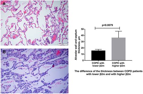 β2 Microglobulin As A Biomarker Of Pulmonary Fibrosis Development In