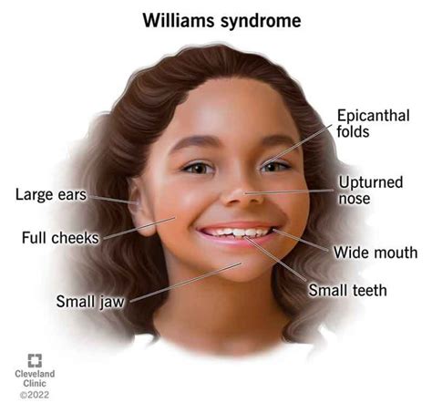 Williams Syndrome Famous People Online Class Time