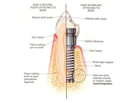 W치과 W치과의 임플란트 고난이도 임플란트 골이식 상악동 거상술
