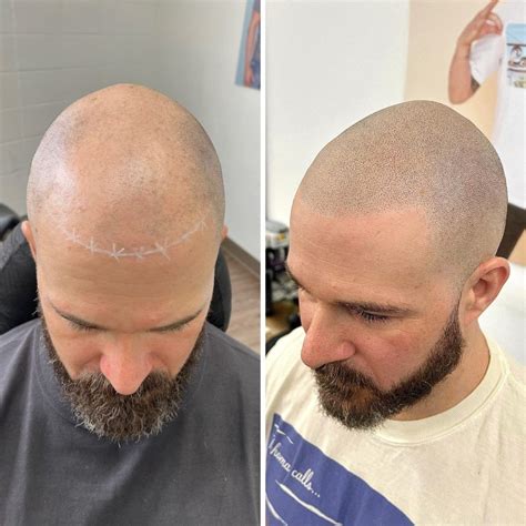 Scalp Micropigmentation In North Carolina Virginia Top Scalp Micro Scalp Micropigmentation In North Carolina Virginia Top Scalp Micro