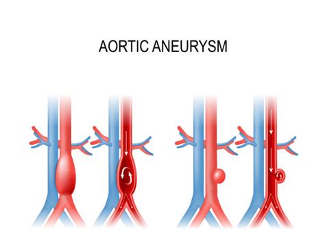 560 Aneurysm Stock Illustrations Royalty Free Vector Graphics And Clip