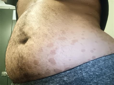 Red Spots All Over My Chest Stomach And Back And Its Itchy R