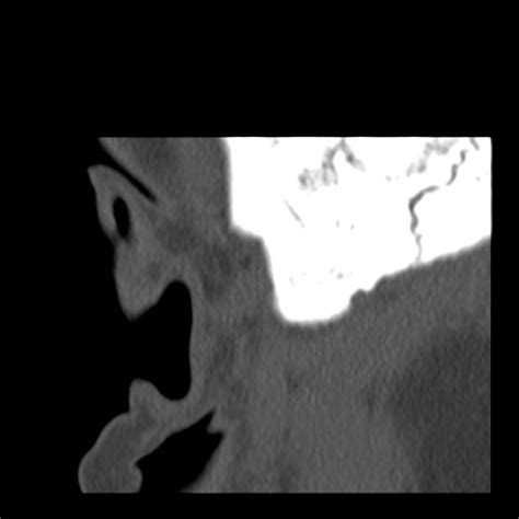 Normal Temporal Bone Ct With Annotated Images Radiopaedia 84293 99584
