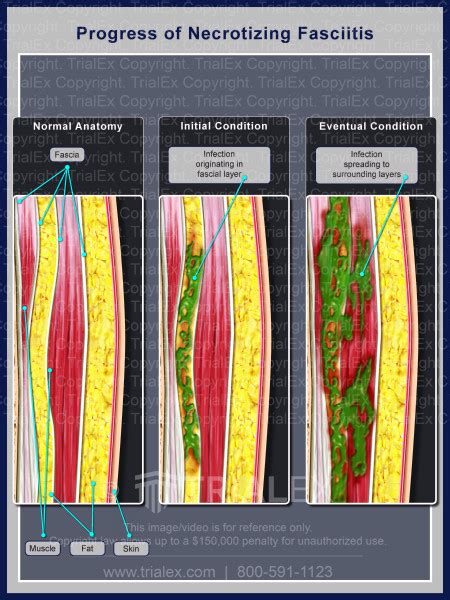 Progress Of Necrotizing Fasciitis Trialquest Inc