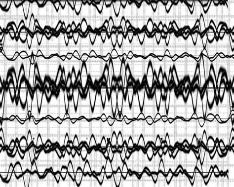 Prédire la survenue dune insuffisance cardiaque aiguë Diabétologie