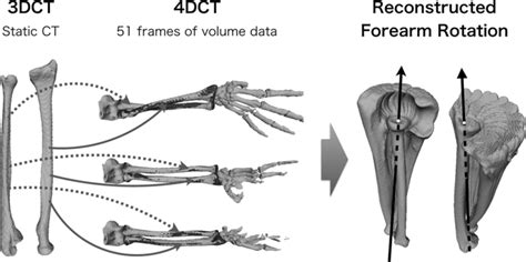 The Whole Surfaces Of The Radius And The Ulna Are Matched With The