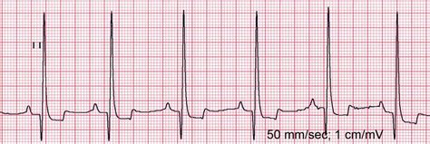 Patent Ductus Arteriosus Cardiorush