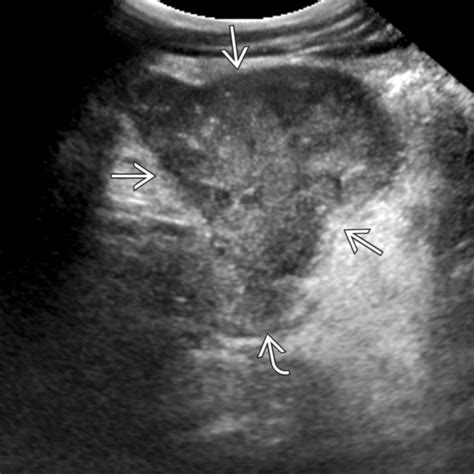 Pancreatic Neuroendocrine Tumor Radiology Key
