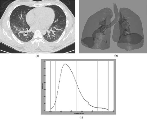 A 53 Year Old Female With Active Acromegaly A End Expiratory Download Scientific Diagram