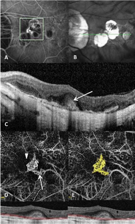 Organized Interlacing Neovascular Pattern Of Active Myopic Cnv Imaged Download Scientific