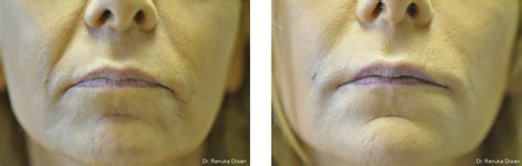 Juvederm For Vertical Lip Lines Before And After Results Fillersupplies