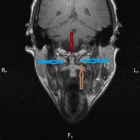Голова соединяется с шейным отделом позвоночником посредством атланто окципитального сочленения