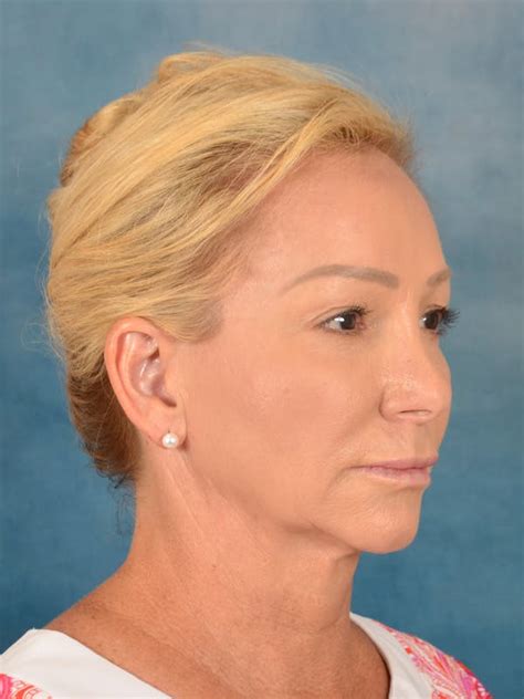 Patient 209353 Laser Skin Resurfacing Before And After Images Dr