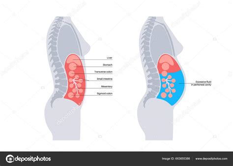 Ascites Anatomy Fluid Peritoneal Cavity Abdominal Distension Pain