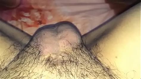 Penectomy Radical Xxx Mobile Porno Videos And Movies Iporntvnet