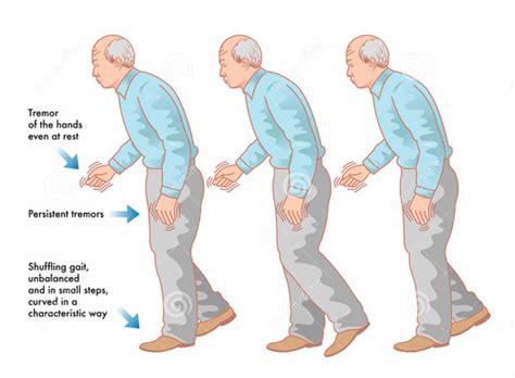 Gait Abnormalities And Plantars Flashcards Quizlet