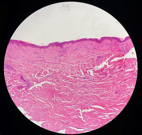 Histopathology Showing Homogenization Of The Whole Dermal Collagen With Download Scientific