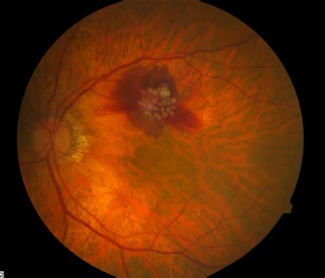 Retinal Macroaneurysm