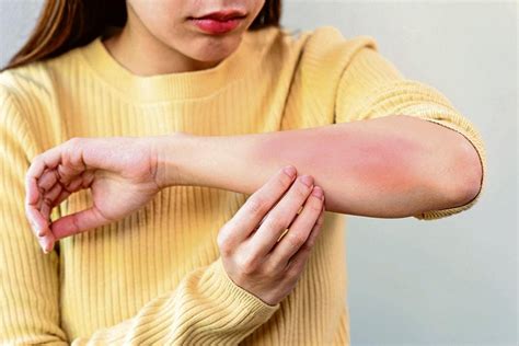 Decoding Dermatomyositis All You Need To Know Hindustan Times