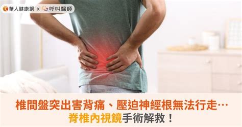 腰椎椎間盤突出害背痛、壓迫神經根無法行走脊椎內視鏡手術解救！