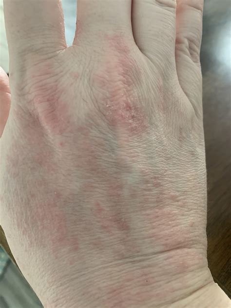 Itchy Raised Bumps Back Of Hands And Fingers During Cold Weather R