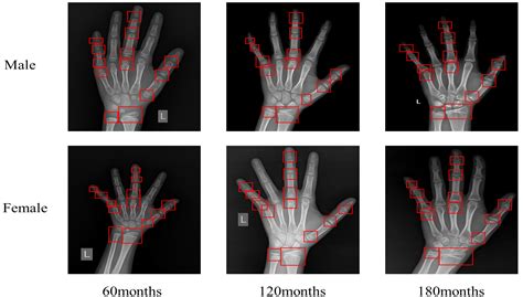Bone Age Estimation Chart Wrist Pe
