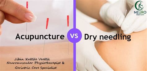 Dry Needling Vs Acupuncture Understanding The Differences And