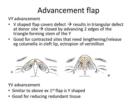 V Y Advancement Flap