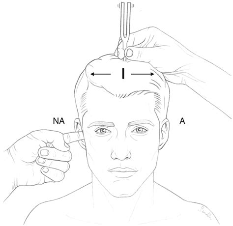 Contralateral Occlusion Test The Effect Of External Ear Canal