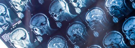 Documenting Acute Encephalopathy In Covid 19 Patients