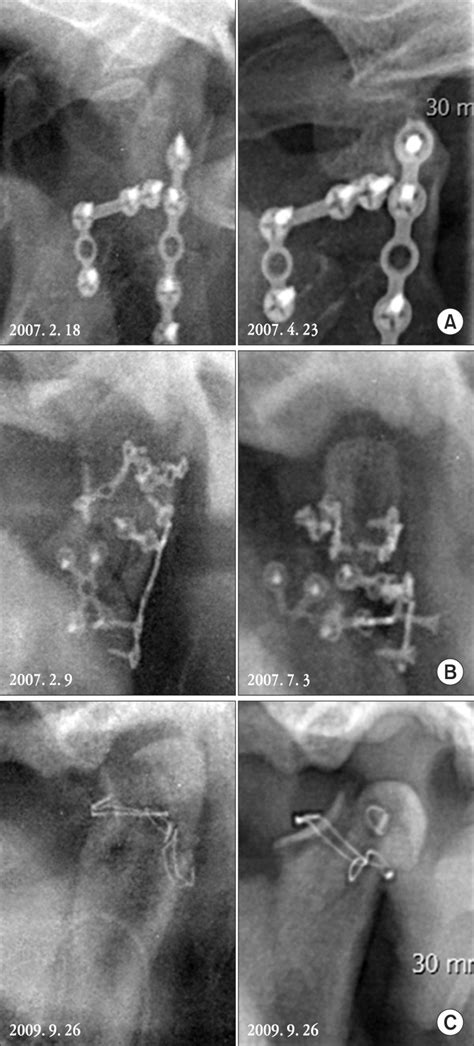 Moderate Resorption Of The Condyle After Extracorporeal Fixation A A Download Scientific
