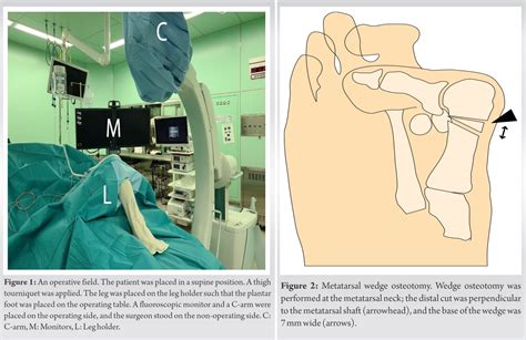 Distal Metatarsal And Proximal Phalangeal Osteotomies Without Soft