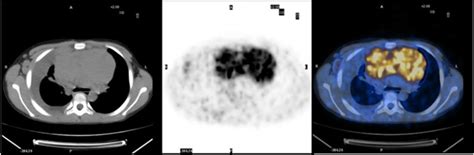 Predictors For Reactive Thymic Hyperplasia And Its Prognostic Value In