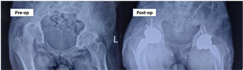 Characterizing Acetabular Defects And Need Of Major Reconstruction