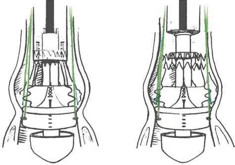 Perceval Plus Valve Implantation Reproduced With Permission From Corcym Download Scientific