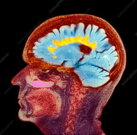 Multiple Sclerosis Sagittal Brain Mri Scan Stock Image C0372390