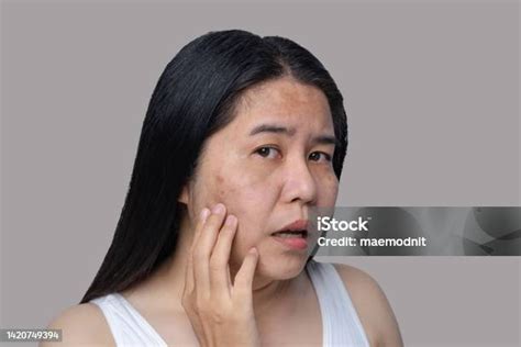 아시아 성인 여성의 얼굴에는 주근깨 큰 모공 여드름 여드름 및 흉터 문제가 오랫동안 돌보지 않아도됩니다 피부 문제는 고립 된