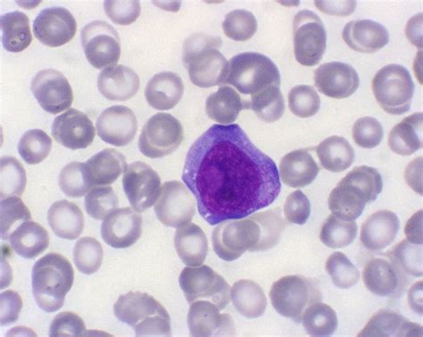 Extranodal T NK Lymphoma Nasal Type