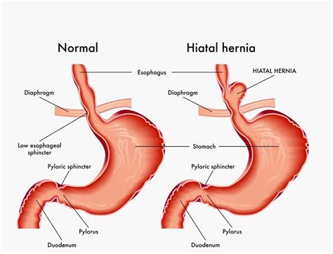 Hiatal Herni Nedir Ankara Masası