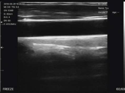 Cardiac Usg Wireless Ultrasound Probe Linear 4d Ultrasound Machine