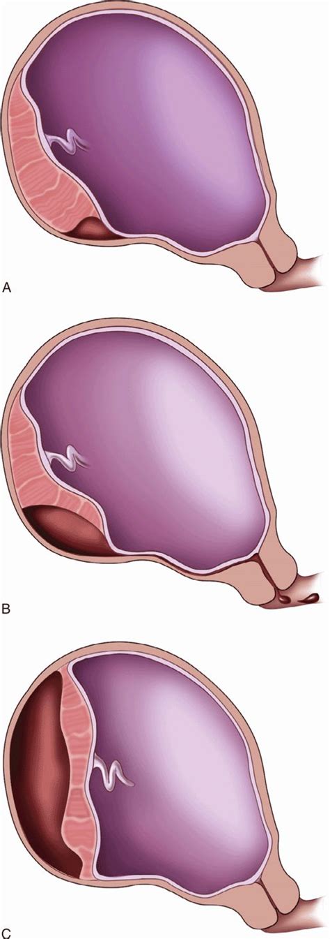 Second And Third Trimester Pregnancy Radiology Key