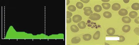 Typical Platelet Histogram And Microscopic Pictures Of Edta Ptcp