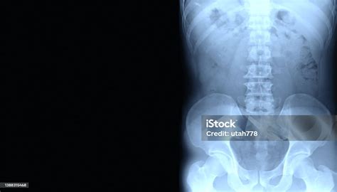 Tulang Belakang Panggul Sendi Pinggul Xray Foto Stok Unduh Gambar
